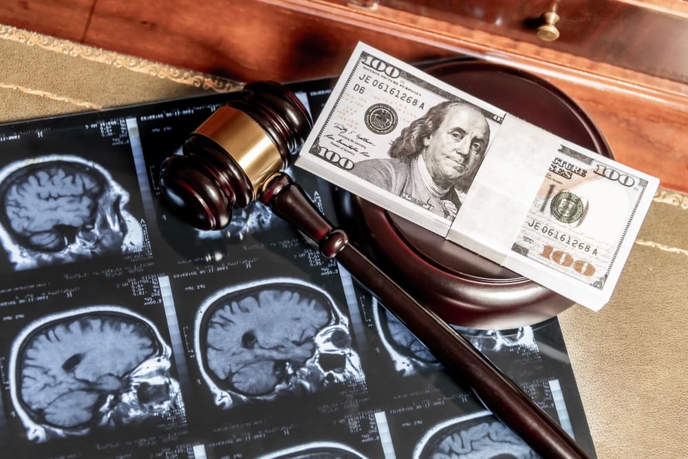 Athens, AL Traumatic Brain Injury Lawyer | TBI Attorney